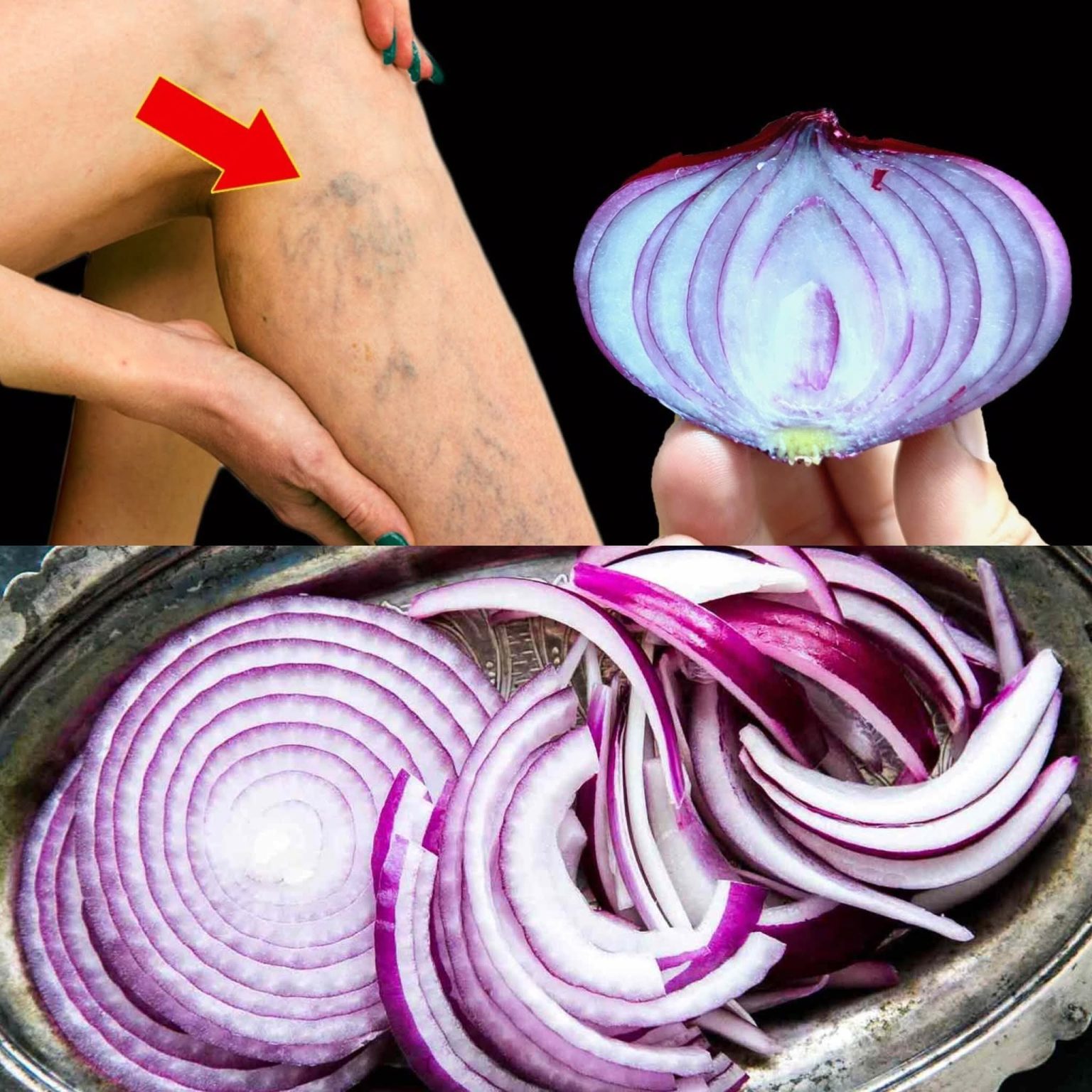 Unbelievable It s a Varicose Vein Killer Red Onion Erases Veins Like an ...